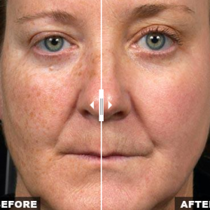 Solta Medical Fraxel SR1500 | Medshare Laser – We Sell New and Used ...